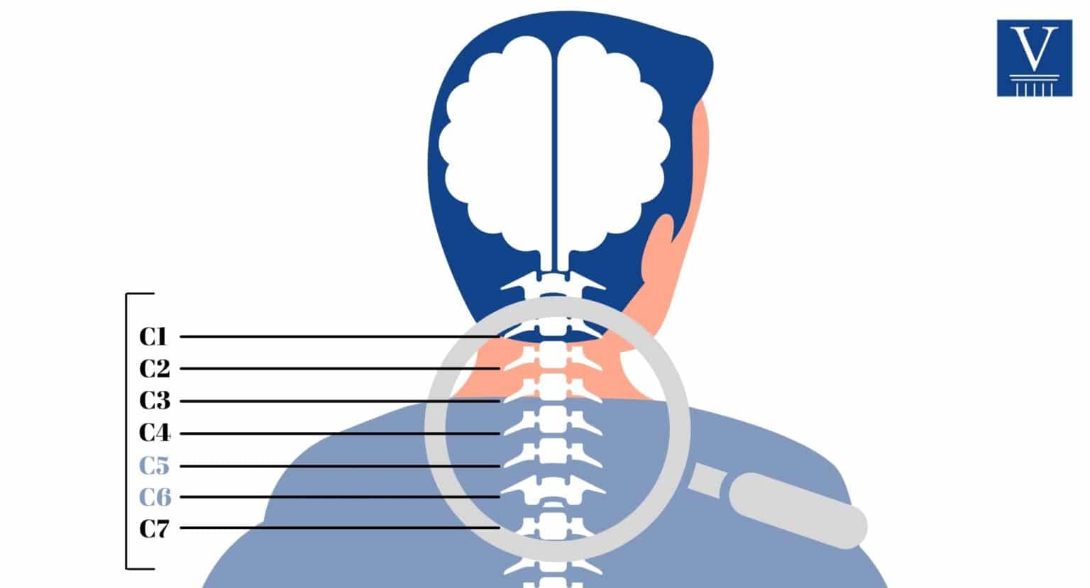 ¿Qué es una lesión C5/C6? - Michael J. Vergis, abogado