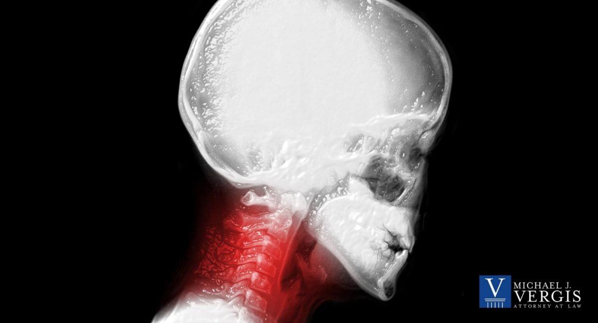 ¿Qué es una lesión C5/C6? - Michael J. Vergis, abogado